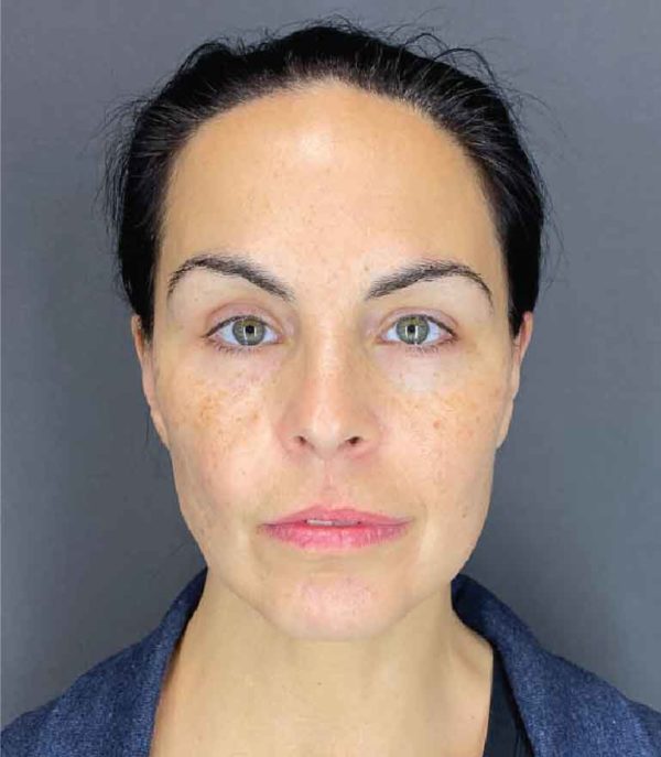 Dermal Fillers Captivating Boutique Aesthetics And Wellness Centre